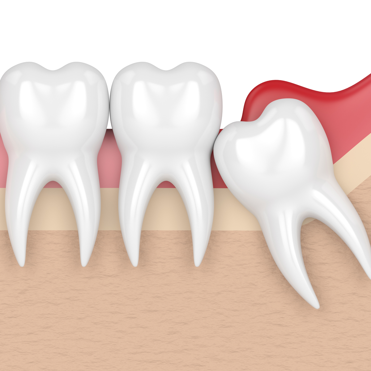 Partially Emerged Wisdom Teeth | Sacramento Dentist, Dr. Grivas ...